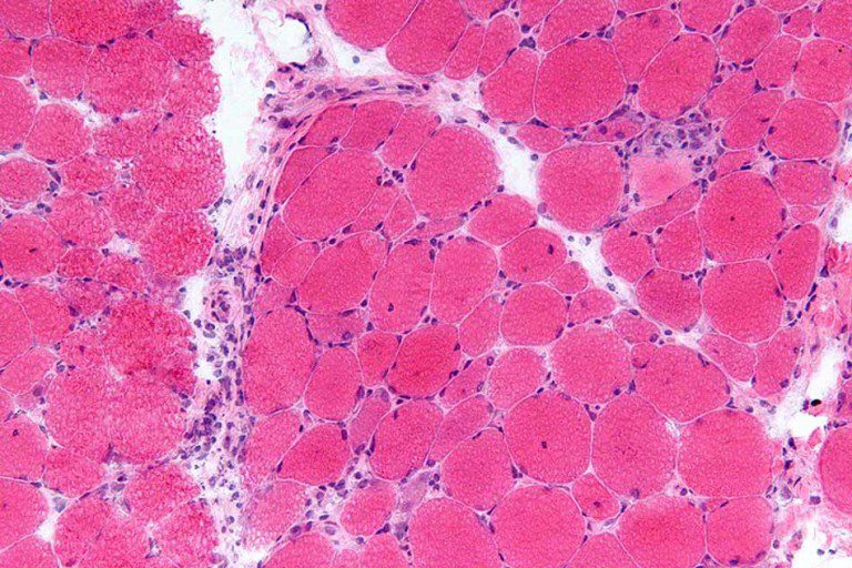 What is Myositis? - Myositis Support and Understanding