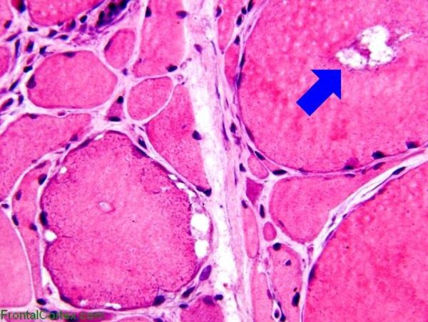 What is Myositis? - Myositis Support and Understanding